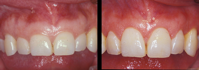 Treatment Gallery - Sterrett Periodontics