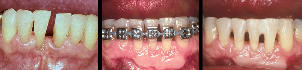 Treatment Gallery - Sterrett Periodontics