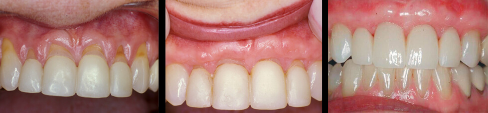 Treatment Gallery - Sterrett Periodontics
